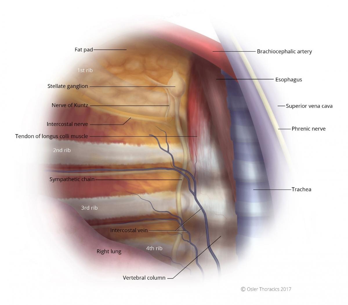 Endoscopic Thoracic Sympathectomy at Virgie Foreman blog